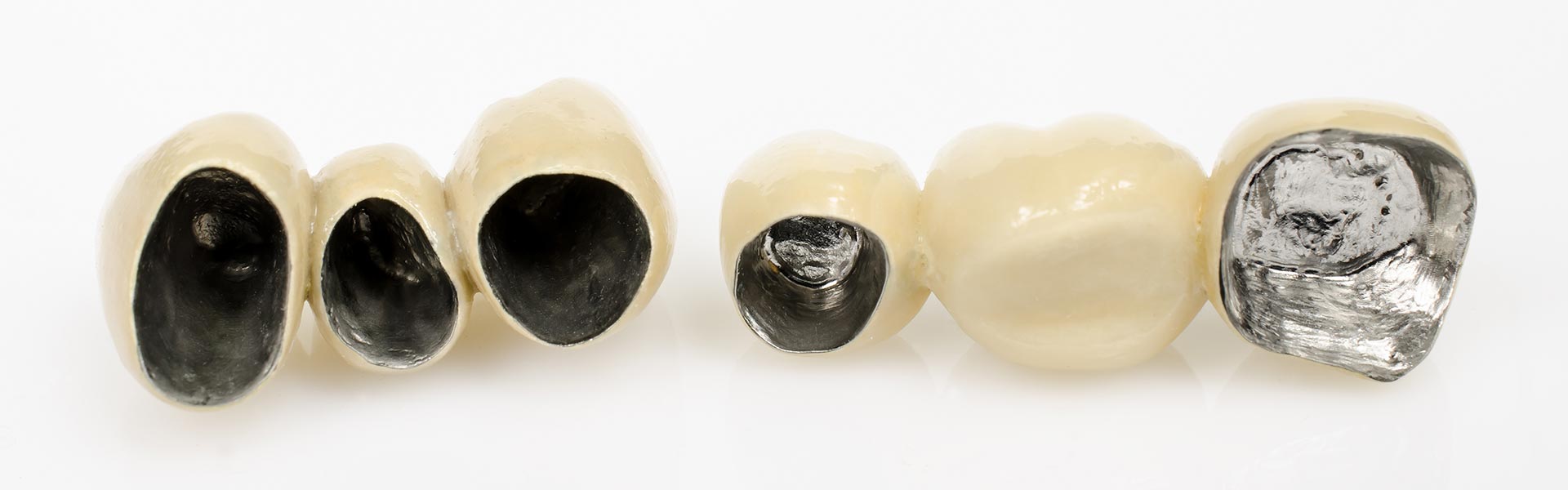 Porcelain Fused to Metal - Scannaire